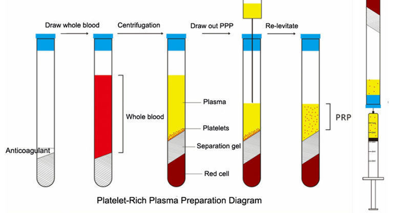 Buy Wholesale China Longtime Classic Prp Kit Platelet Rich Plasma 30ml ...