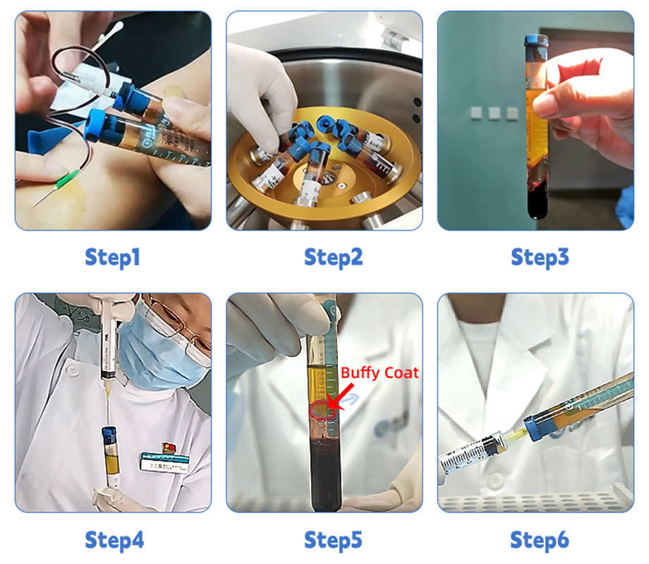 Buy Wholesale China Longtime Classic Prp Kit Platelet Rich Plasma 30ml ...