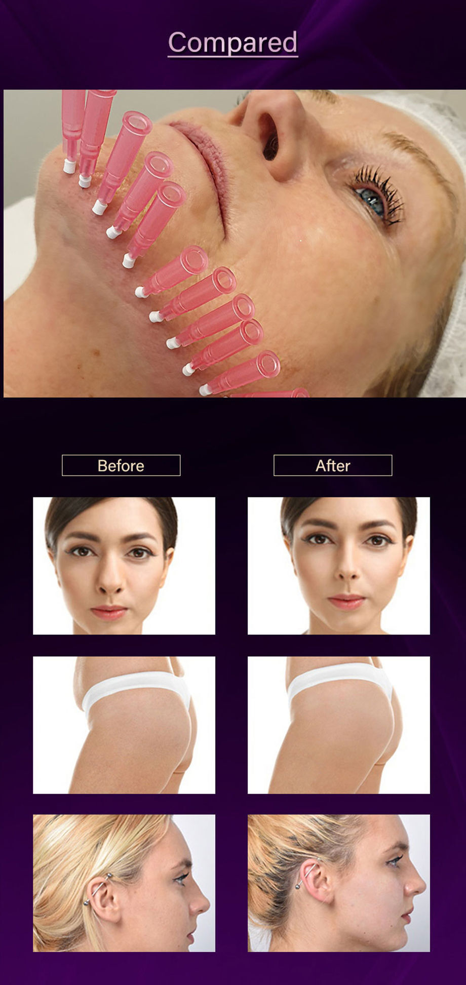 Buy Wholesale China Korea Absorbable Pcl Thread Lift Barbed Cog ...