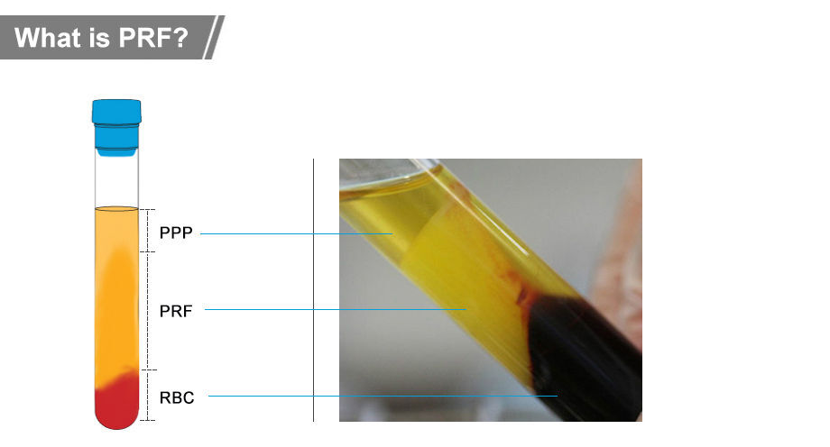 Buy Wholesale China Longtime Platelet Rich Fibrin 10ml Prf Tube With ...