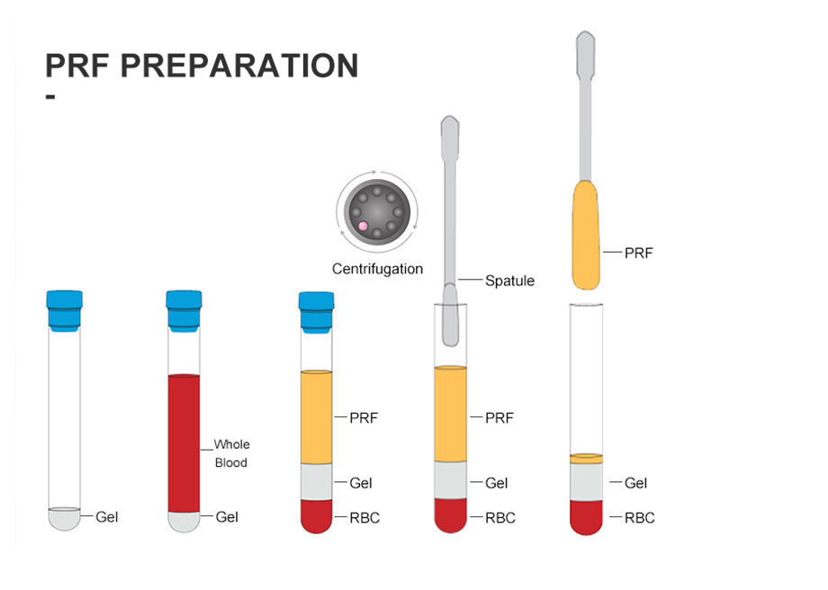 Buy Wholesale China Longtime Platelet Rich Fibrin 10ml Prf Tube With ...