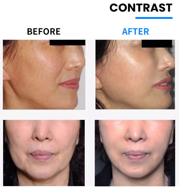 Buy Wholesale China Face Lifting Pdo Thread Collagen Hilos Cog 4d 21g ...