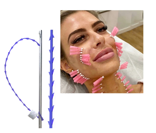 Buy Wholesale China Sterile Absorbable Lift Thread Body Tightening ...