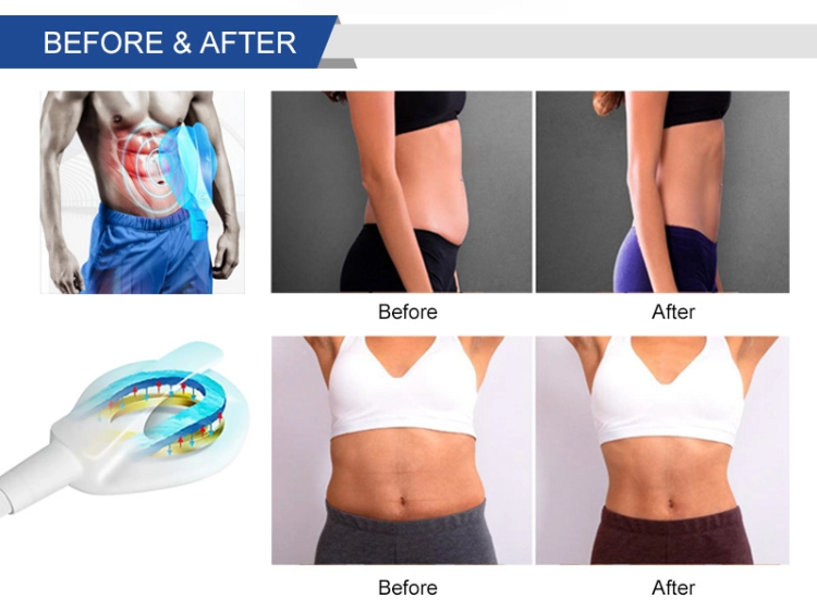 Buy Wholesale China New Portable Fat Burner Cellulite Removal Ems ...