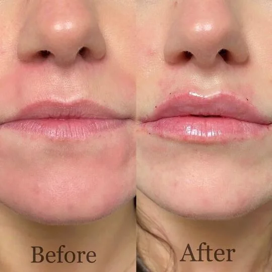 Buy Wholesale China Wholesale Sanendi Fat Dissolving Lipolab Kebelline ...