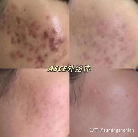 Buy Wholesale China Korea New Product Asce Plus Derma Signal Kit Srlv-s ...