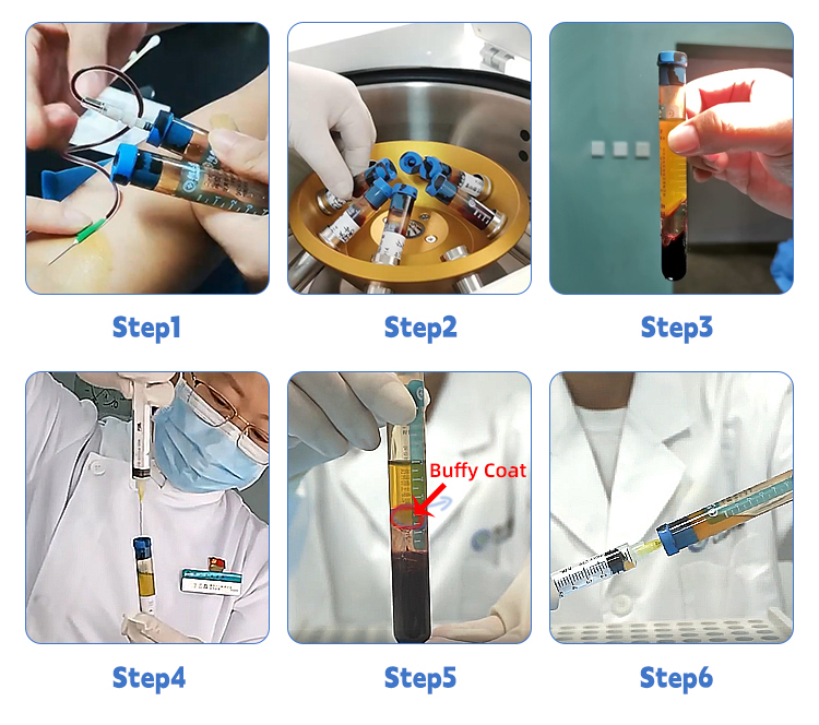 Buy Wholesale China Longtime Medical Platelet Rich Plasma Prp Tube 10ml ...