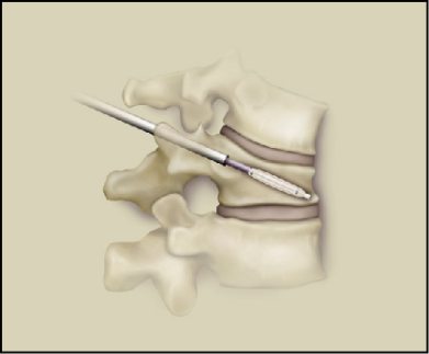 Bulk Buy China Wholesale Minimally Invasive Surgery Kyphoplasty Ballon ...