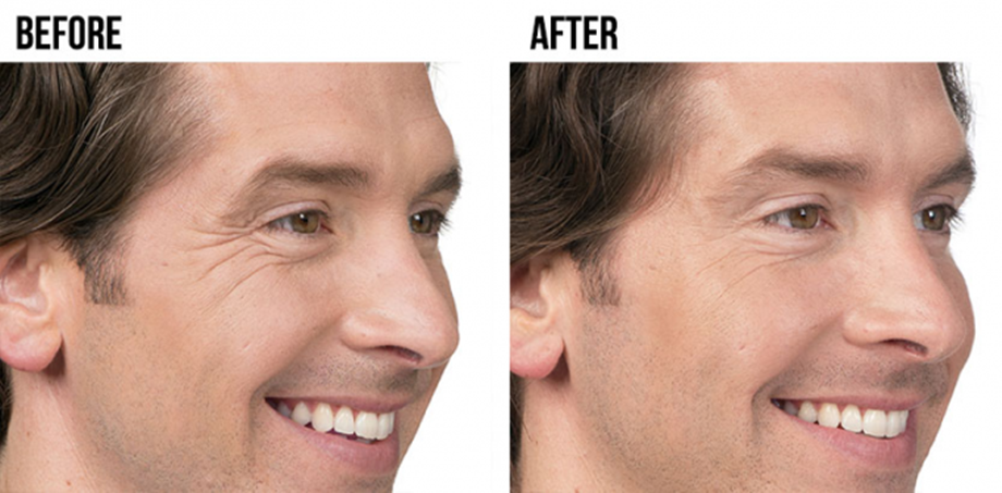 Buy Wholesale China Allergan Botoxs Botulinums 100iu Anti Wrinkles ...