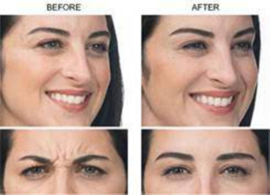 Buy Wholesale China Allergan Botoxs Botulinums 100iu Anti Wrinkles ...