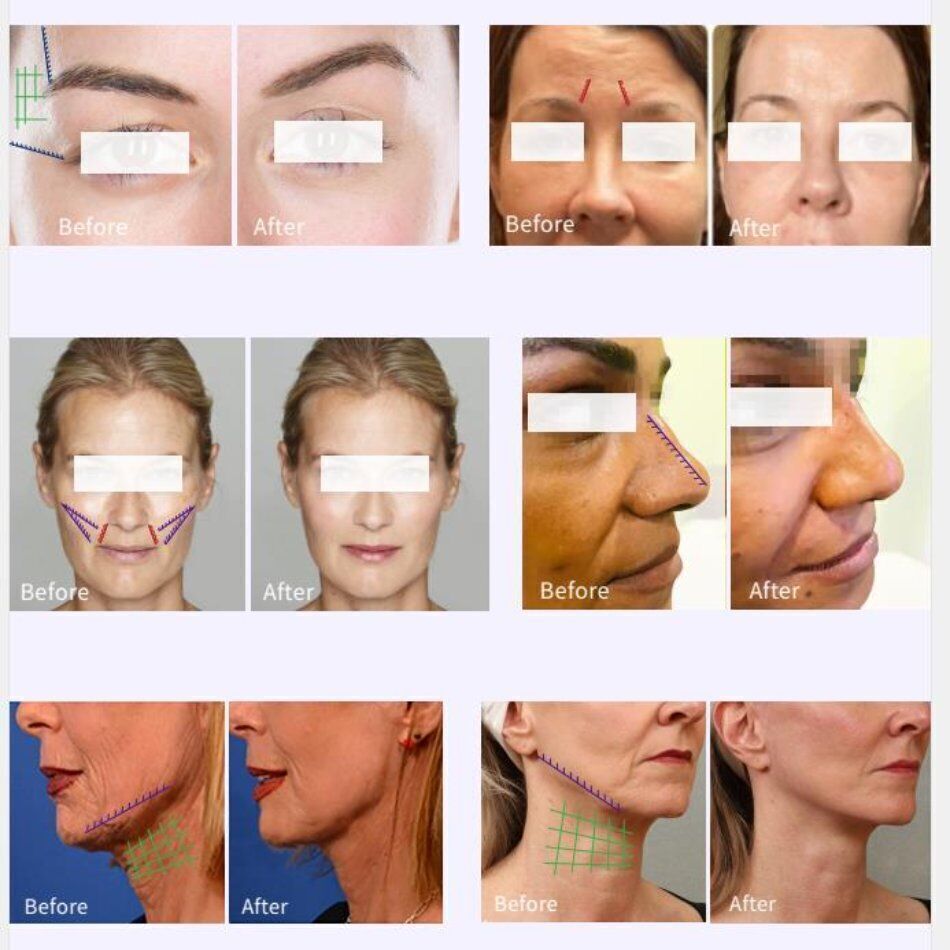 Buy Wholesale China Minerva Ce Approved Hilos Skin Tensioning Double ...