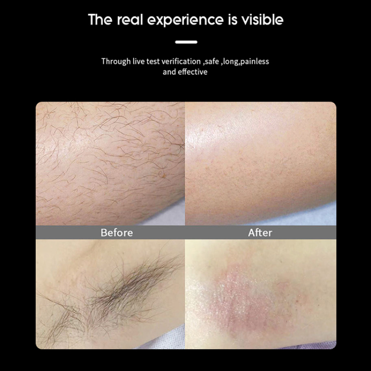 4k Screen Laser Hair Removal Diode Laser 3 Wavelengths 755 808 1064 ...