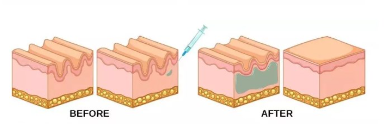 Buy Wholesale China 1ml 2ml 10ml 20ml Dermal Filler Cross Linked ...