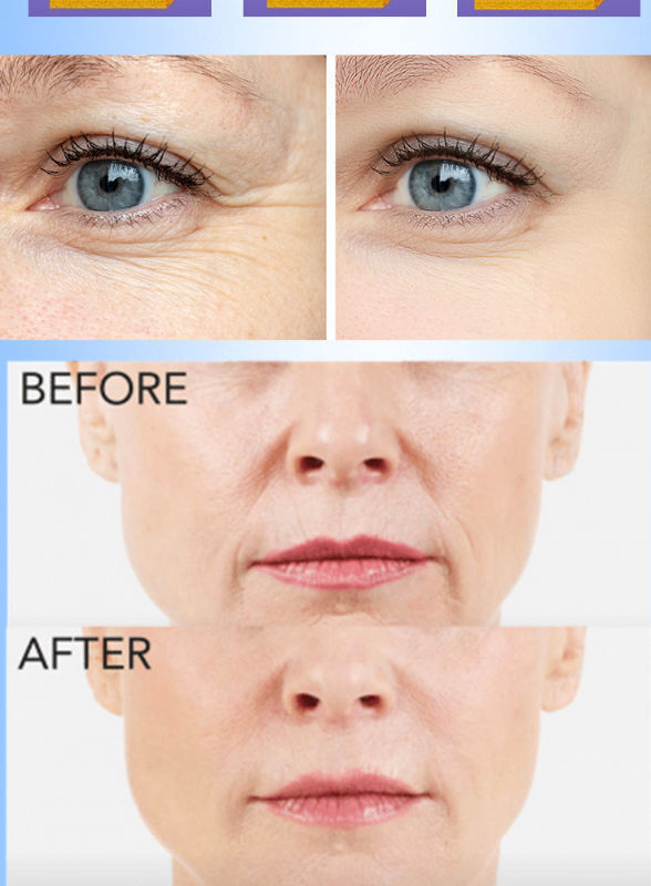 Buy Wholesale China Radiesses Dermals Fillers 1.5cc Used For Facial ...