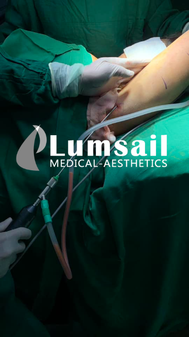 Buy Wholesale China Surgical Smart Lipo Equipment Power Assist Suction ...