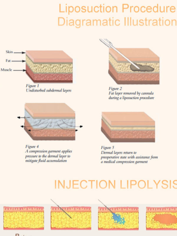 Buy Wholesale China Semaglutidees Ozempic's Filled Fat-dissolving Pen 0 ...