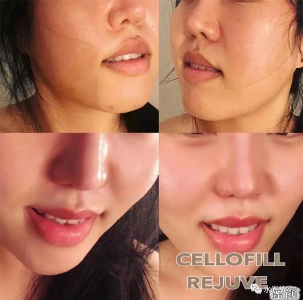 Buy Wholesale China Korean Skin Care Products Cellofill Gp60 Injectable ...