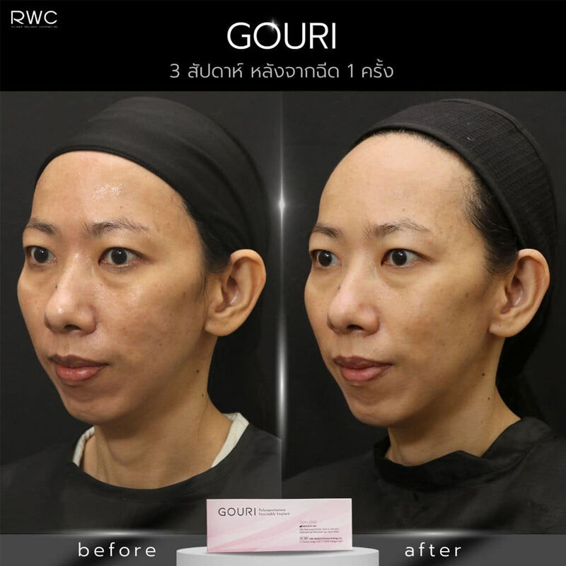 Buy Wholesale China Korea Original Gouri 21% Pcl (polycaprolactone ...