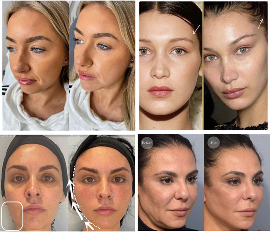 Buy Wholesale China Rejeon Pdo Threads Monos For Eyes Thread Lift Pdo ...