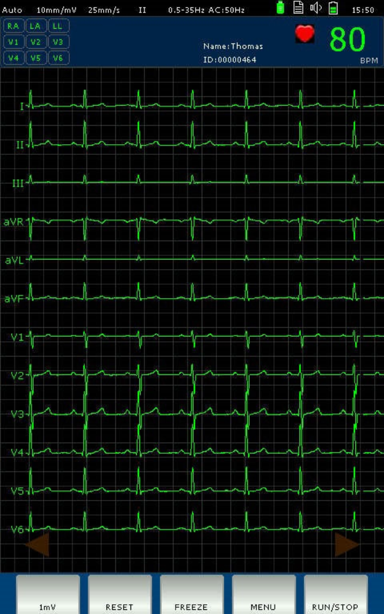 Dawei 12 Lead Ekg 12 Channel Ecg Machine - Explore China Wholesale Ekg ...