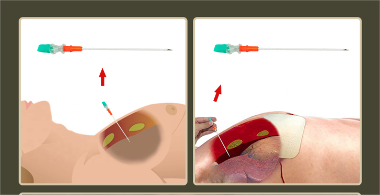 Medresq Medical Decompression Needle Pneumothorax Piercing Needles - China Wholesale ...