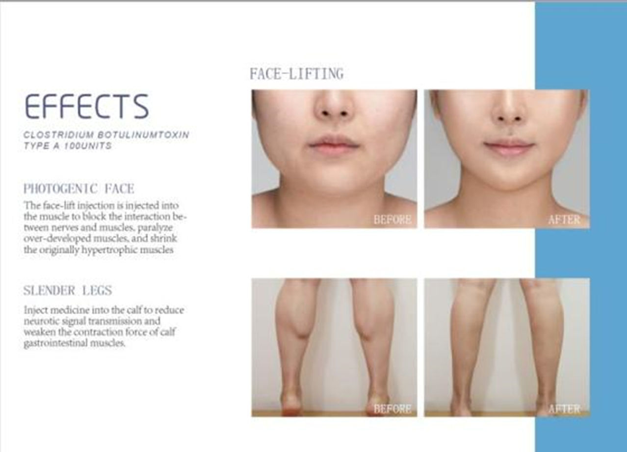 Buy Wholesale China Ellelux Botulax's Toxin Type A 100 Units Injection ...