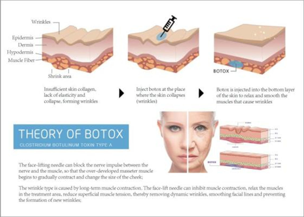 Buy Wholesale China Ellelux Botulax's Toxin Type A 100 Units Injection ...