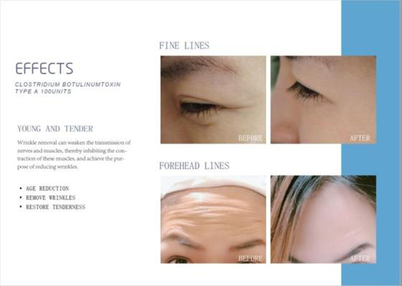 Buy Wholesale China Ellelux Factory Price Botulax's Toxin Bacilli ...