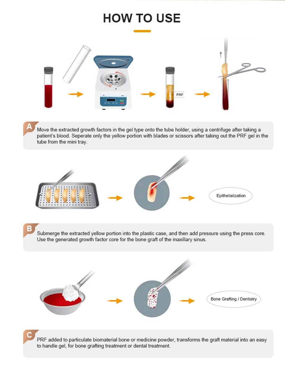 Buy China Wholesale Prf Box Platelet Rich Fibrin Dental Implant Surgery ...