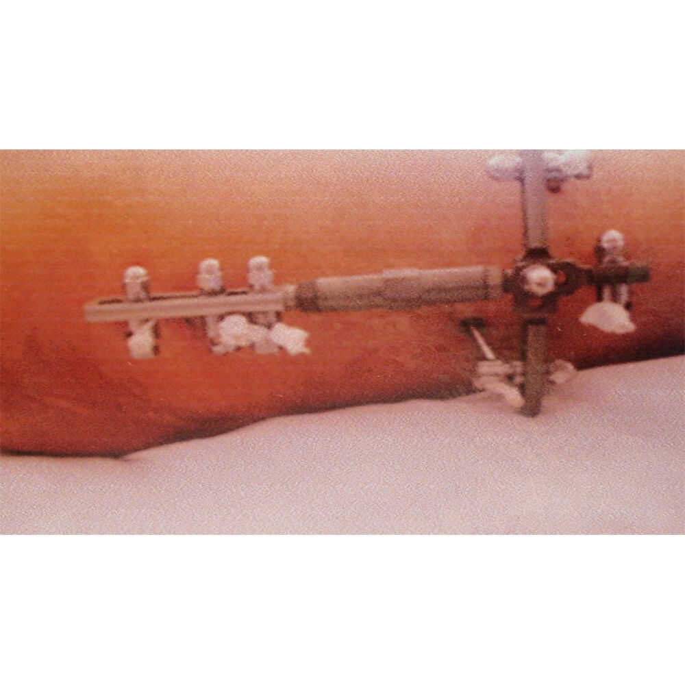 Orthopedic Surgical External Fixation Multifunctional External Fracture ...