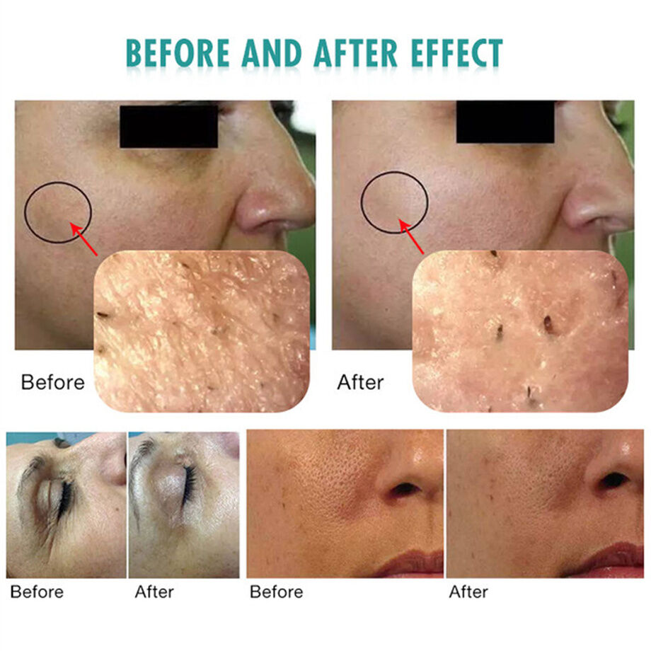 Buy China Wholesale Skin Care Pollogen Co2 Oxygenation 3 In 1 Oxygeneo ...