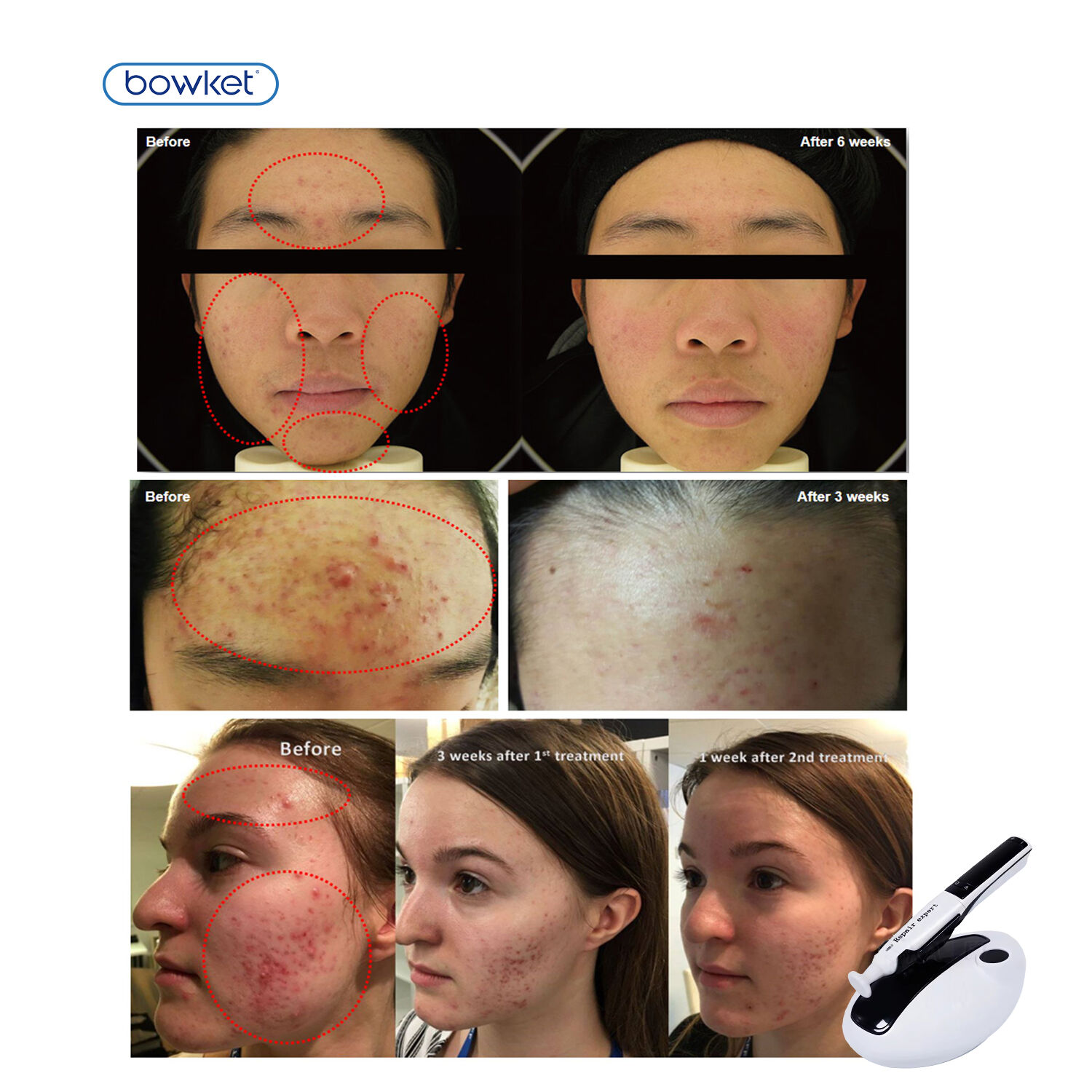 Buy China Wholesale Bowket Plasma Pen Beauty Korea Plasma Skin ...