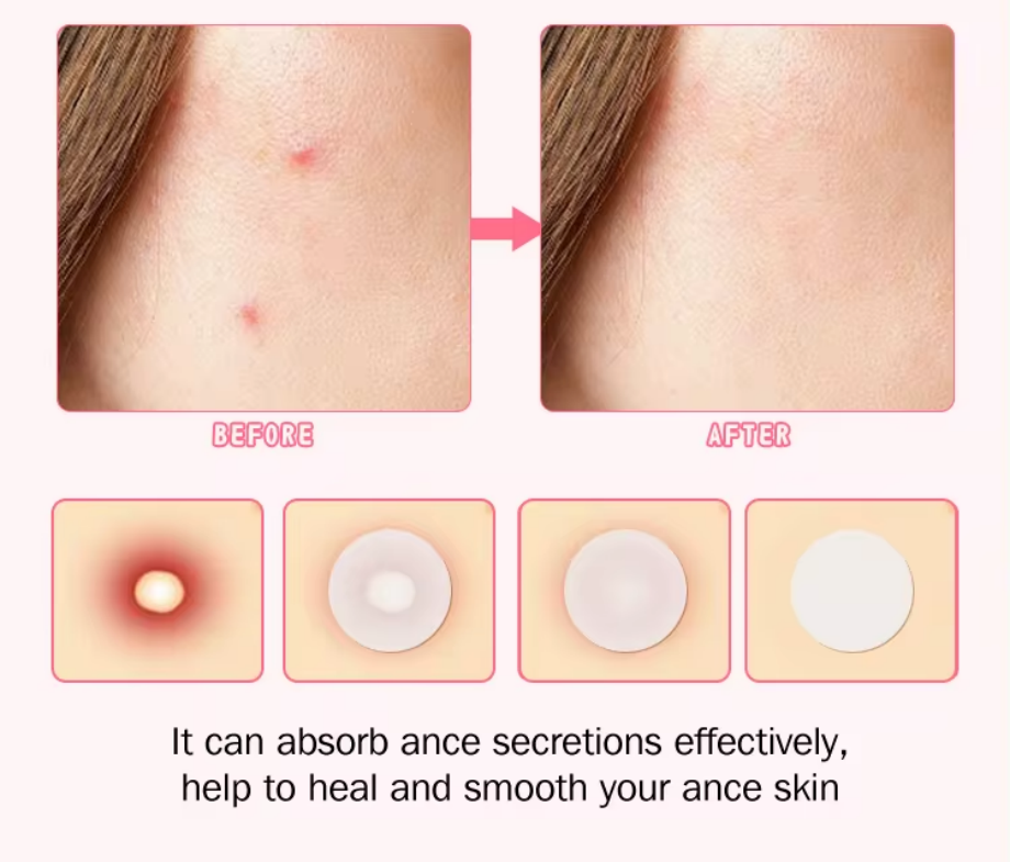 Factory Price Hot Selling Acne Absorbing Cover Patch Pore Cleansing ...