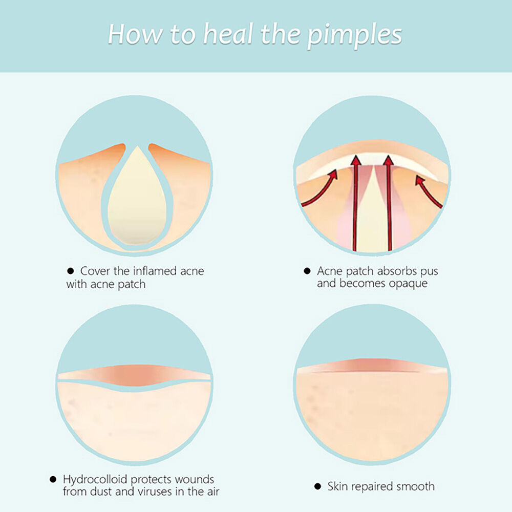 Wholesale Hydrocolloid Ance Patch Custom Pimple Patch With Gem $0.32 ...