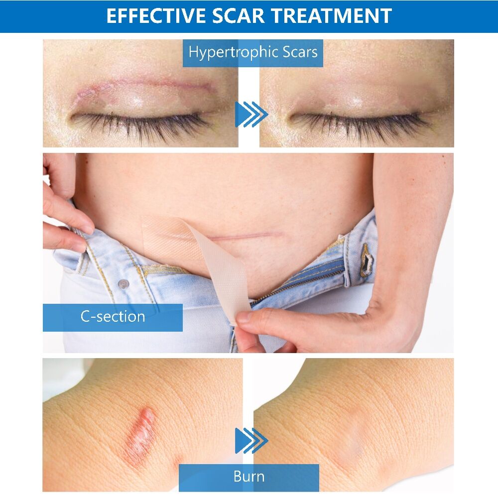 Manufacturer Medical Grade Silicone Roll Scar Removal For Face And Body ...