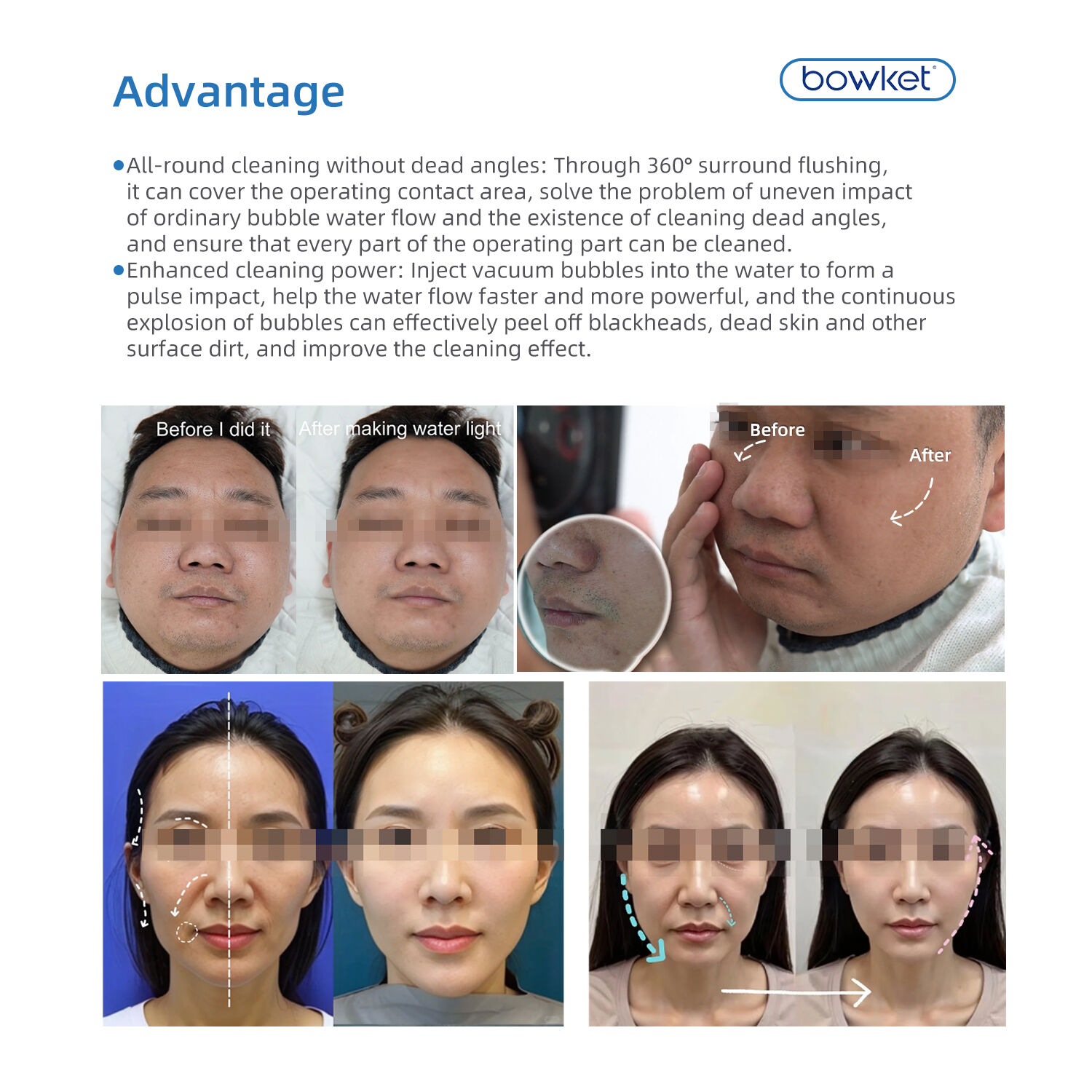 Bowket Facial Care Dermabrasion Mesotherapy High Pressure Jet Peel ...