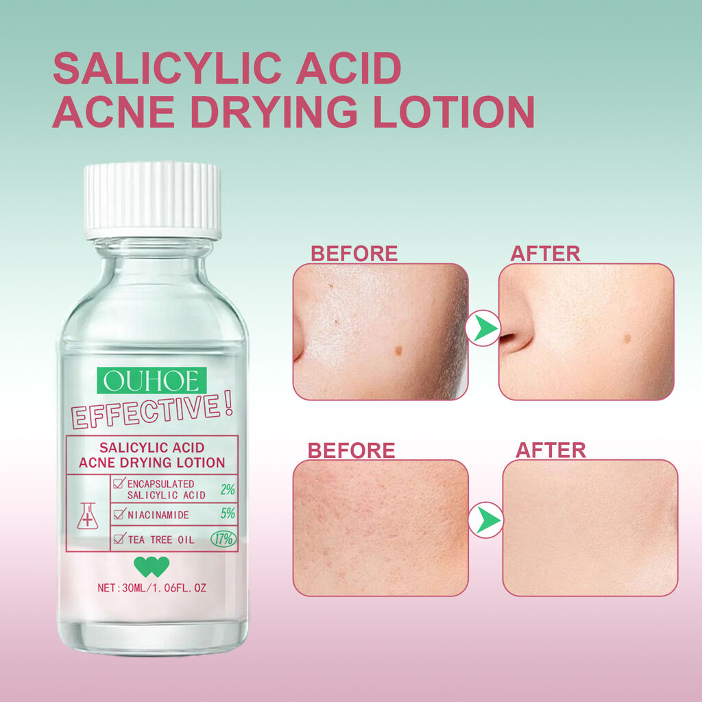 Bulk Buy China Wholesale Ouhoe Salicylic Acid Acne Drying Lotion ...