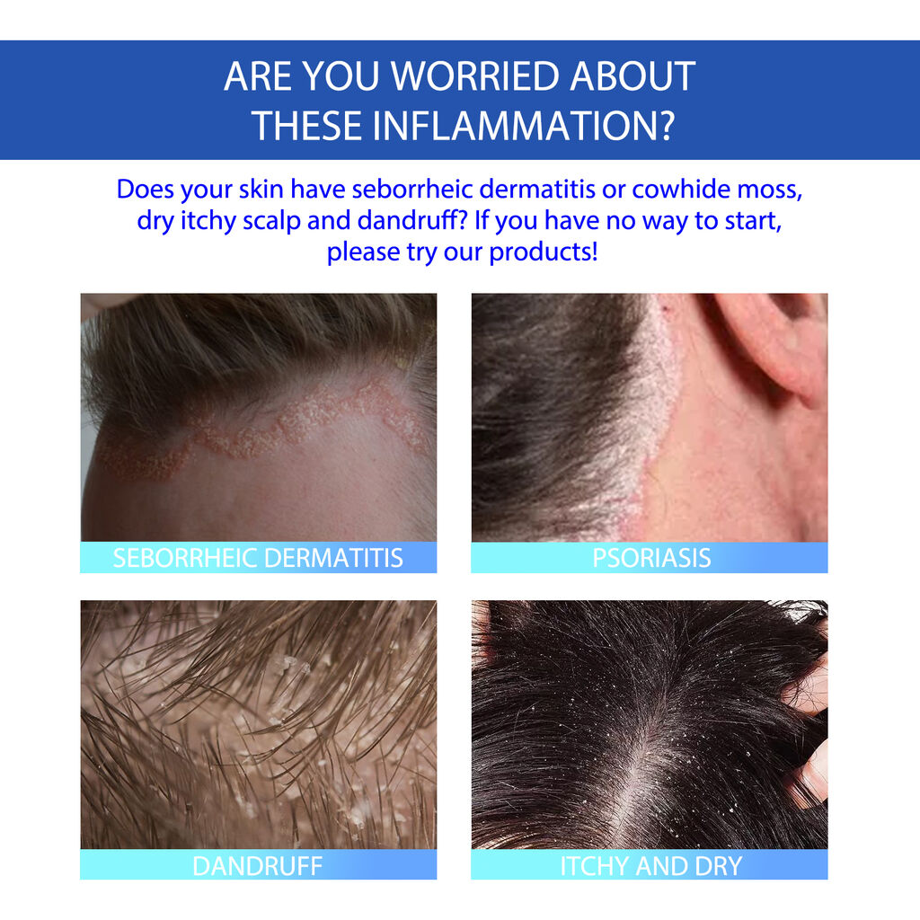South Moon Seborrheic Dermatitis Cream Bacteriostasis Relieves Itching ...