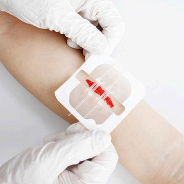 Wound closure device | Global Sources