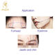 Buy Wholesale China Jawline Neck Pdo Threads Mono Double Needle ...