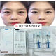 Buy Wholesale China Teoxane Teosyal Redensity Ii For Eye Wrinkles ...